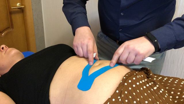 Наложение кинезио тейпа при расхождении белой линии живота. Диастаз.