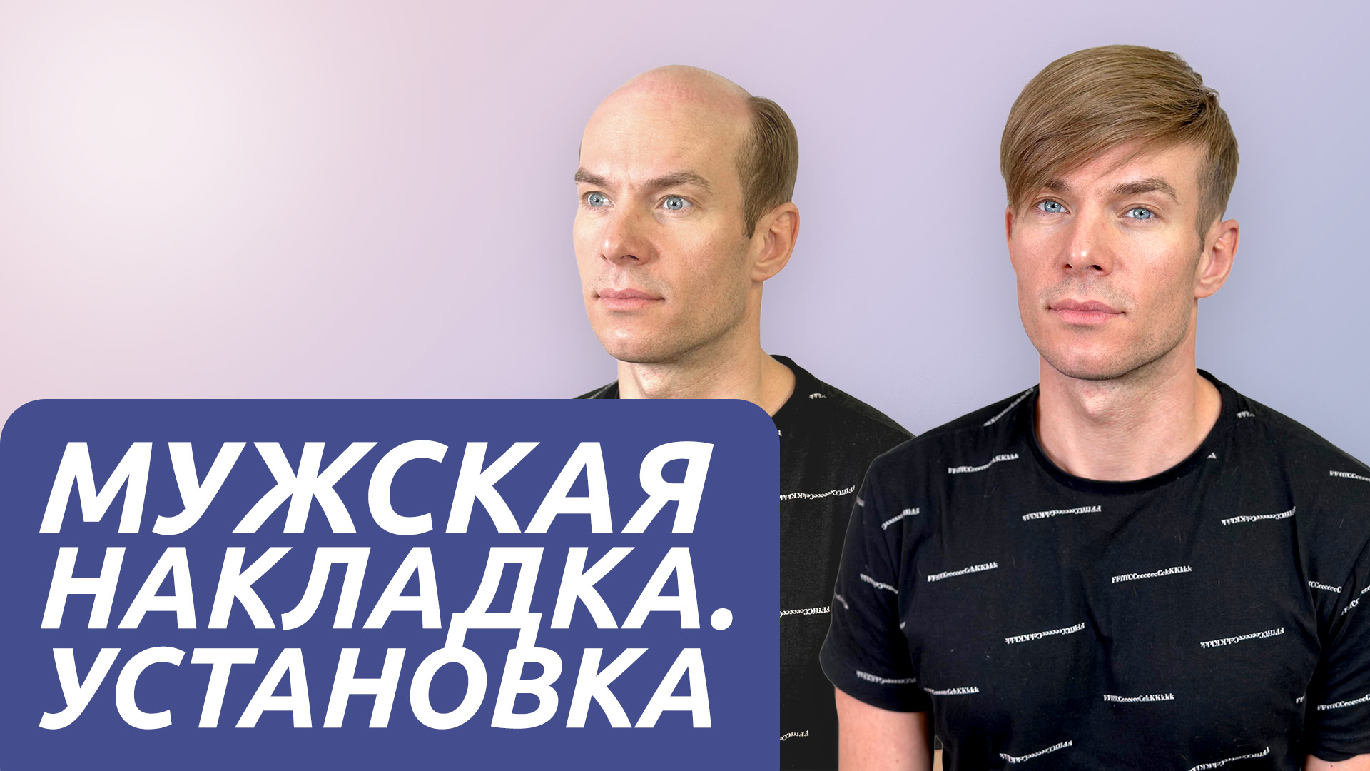 Алопеция у мужчин. Мужская система замещения волос. Фиксация накладки из волос. До и после.