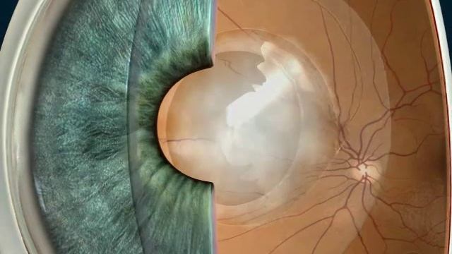 Вторичная катаракта