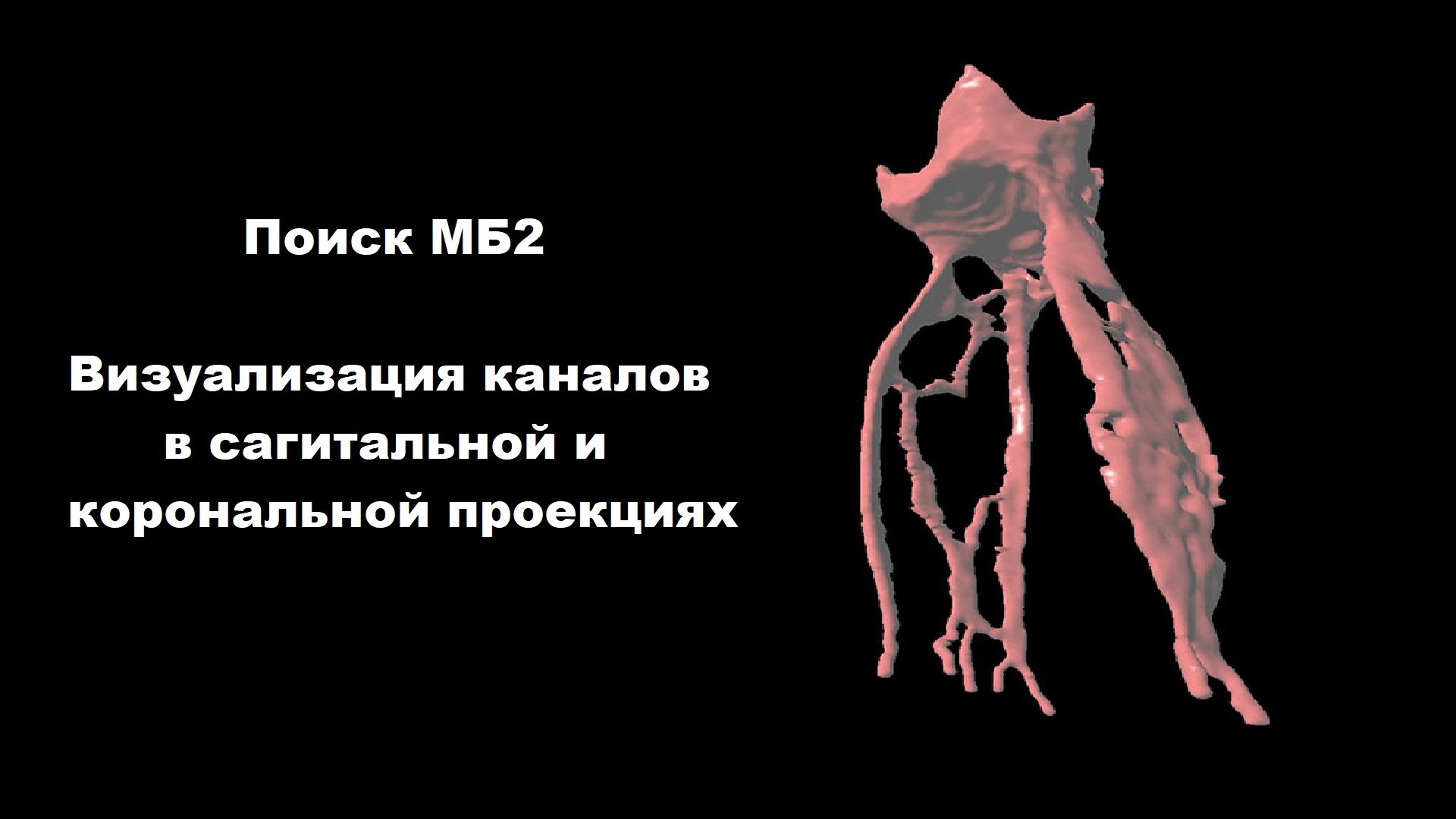 Поиск МБ2 и визуализация каналов медиально-щечном корне.