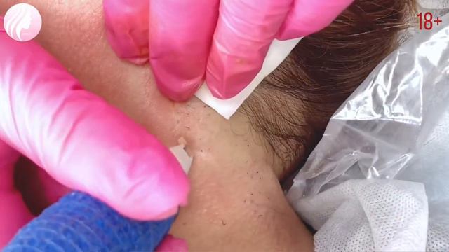 Остались ШРАМЫ после подтяжки лица SMAS LIFTING. Камуфляж шрамов процесс