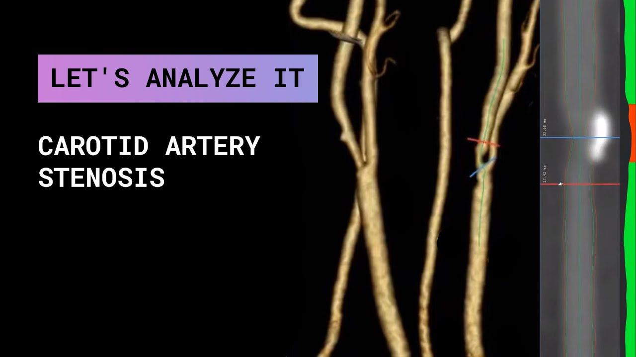 Давайте проанализируем. Стеноз сонной артерии