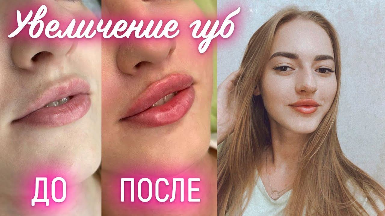 УВЕЛИЧЕНИЕ ГУБ ВТОРОЙ РАЗ   ОЩУЩЕНИЯ ВО ВРЕМЯ ВКОЛОВ  РЕЗУЛЬТАТ НЕ ОПРАВДАЛ ОЖИДАНИЯ