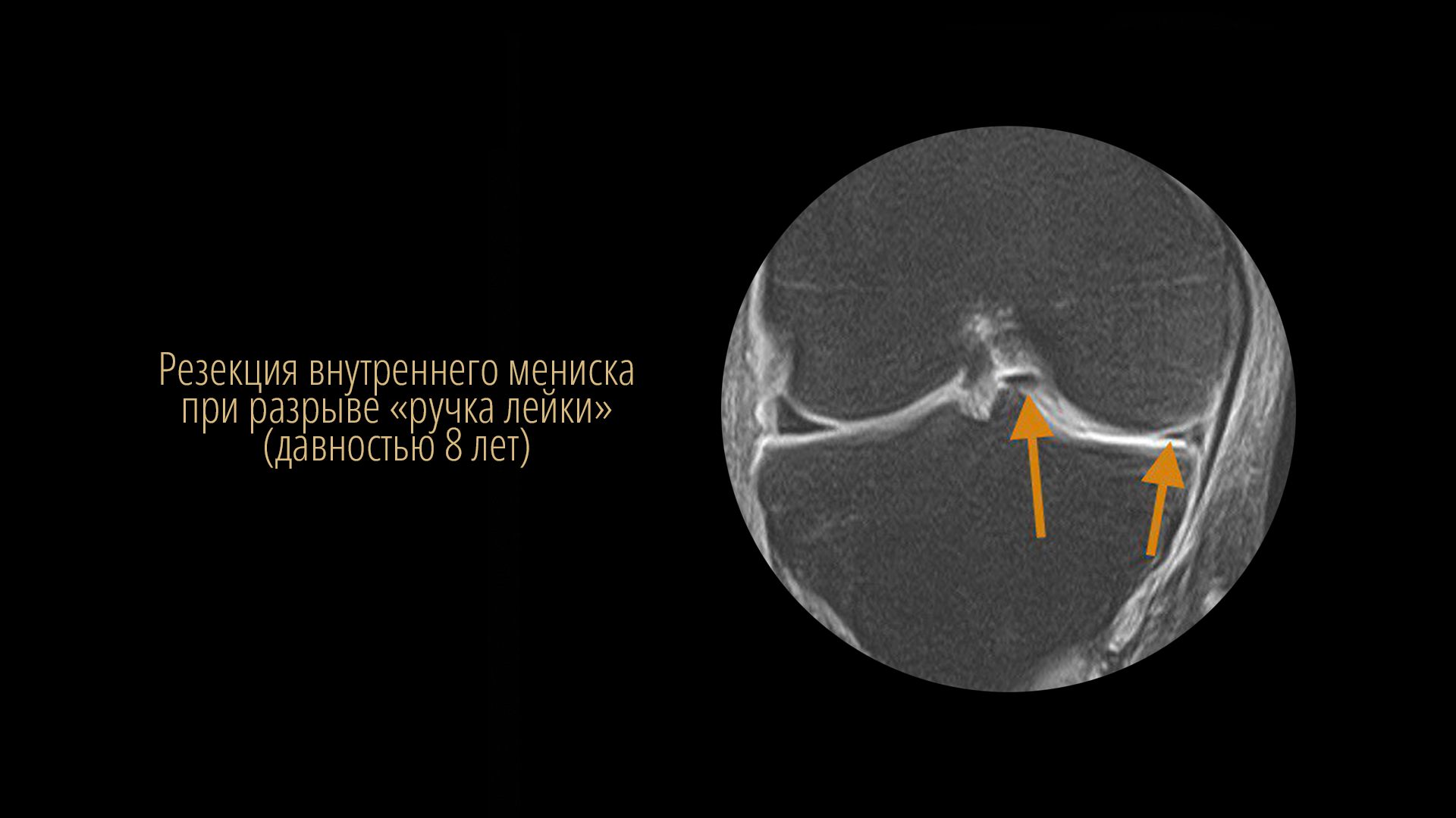 Резекция внутреннего мениска при разрыве «ручка лейки»
