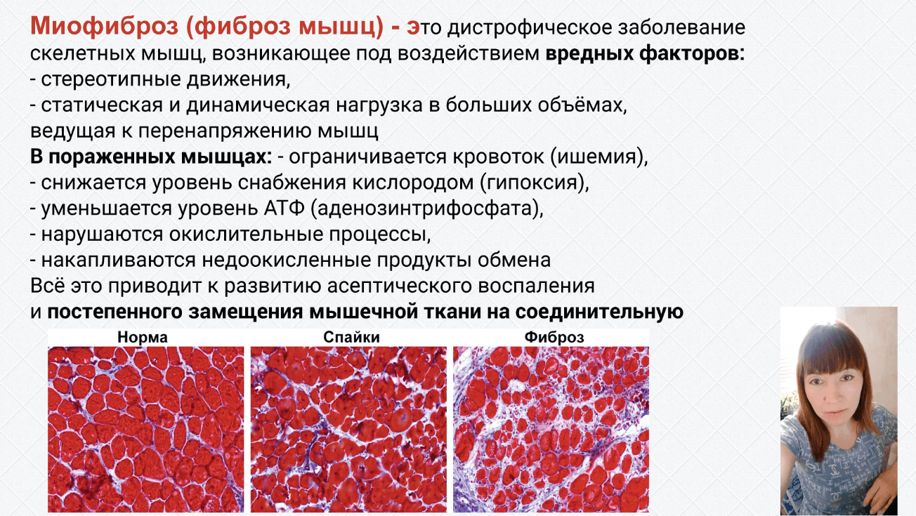 Моя история болезни и лечения. Миофиброз. Миофасциальный синдром (МФС). Фиброз мышц живота
