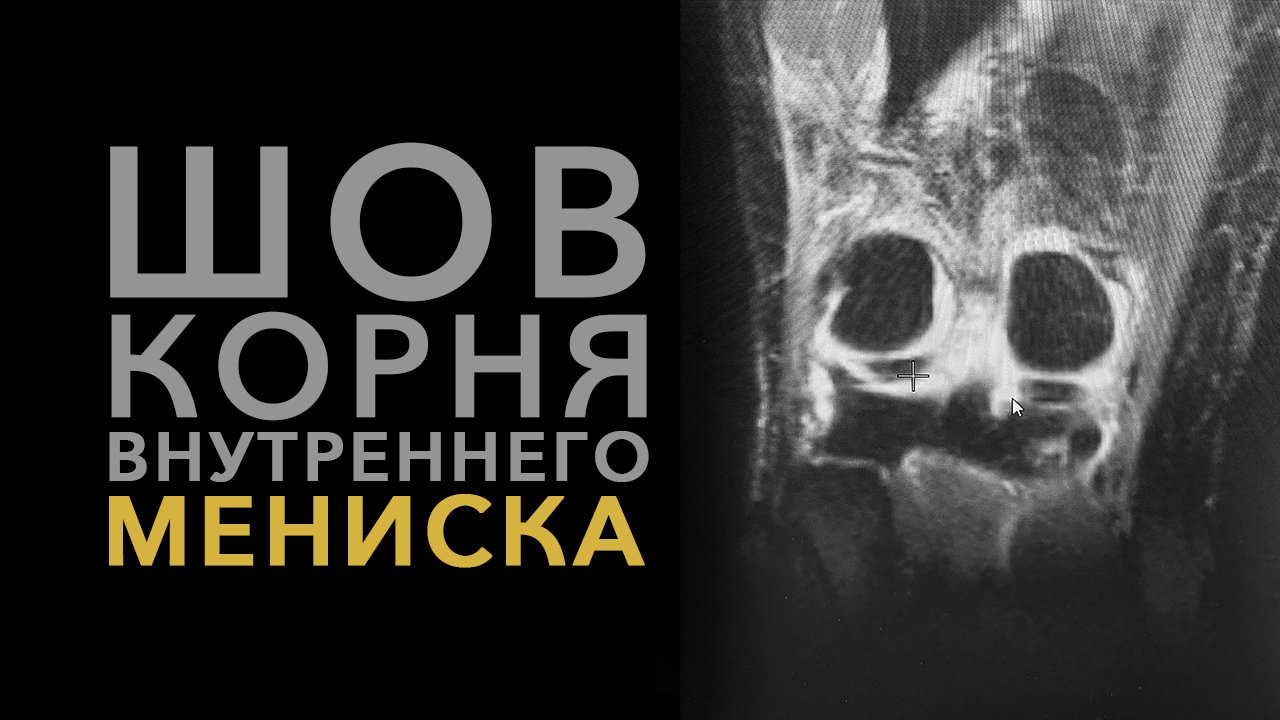Шов корня внутреннего мениска