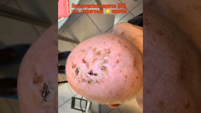 Солнечный кератоз