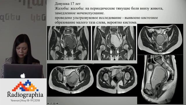 Дифференциальная диагностика кистозных образований малого таза. Ирина Анненкова