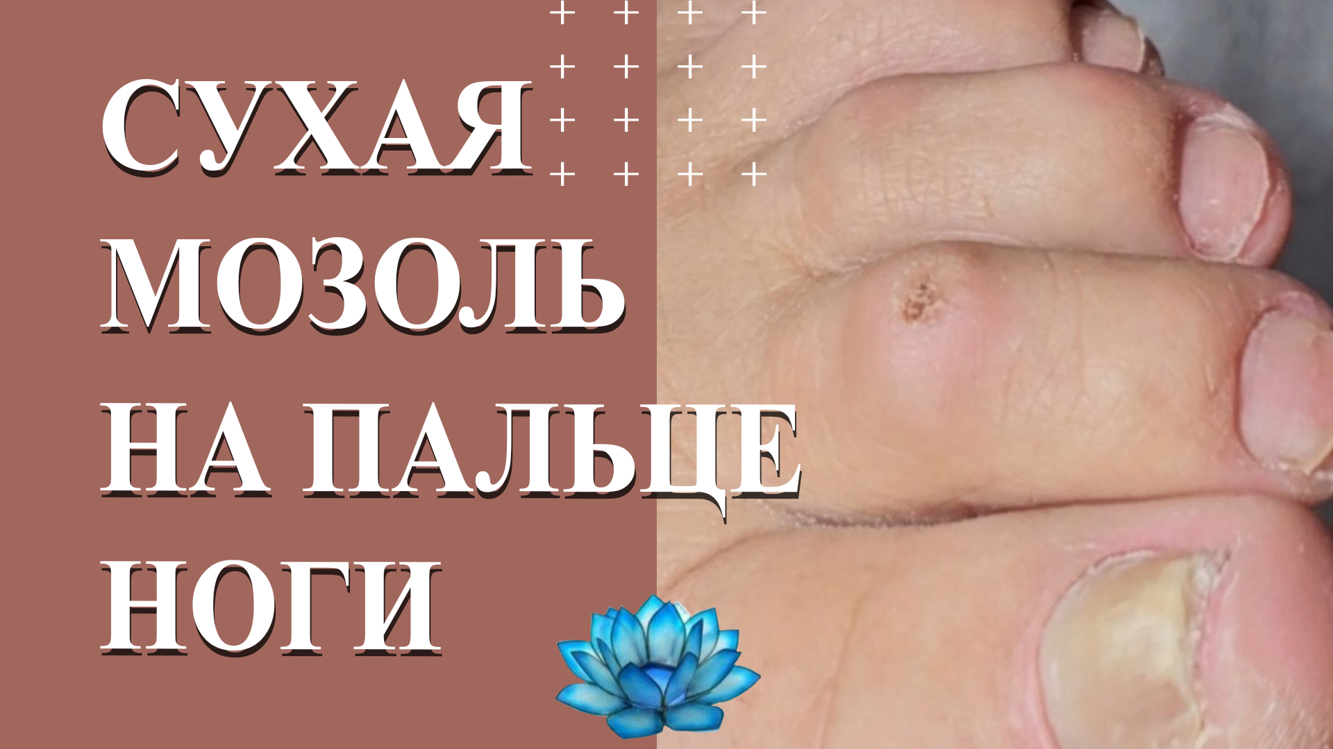 Мозоль на пальце ноги. Что делать?