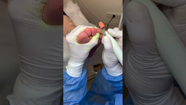 Медицинский педикюр, грибок ногтей удаление. Подолог Симферополь. Центр подологии Стельмаковой.