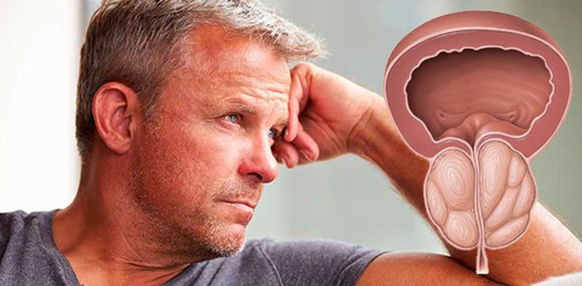 Аденома простаты.Начало.Как лечат...