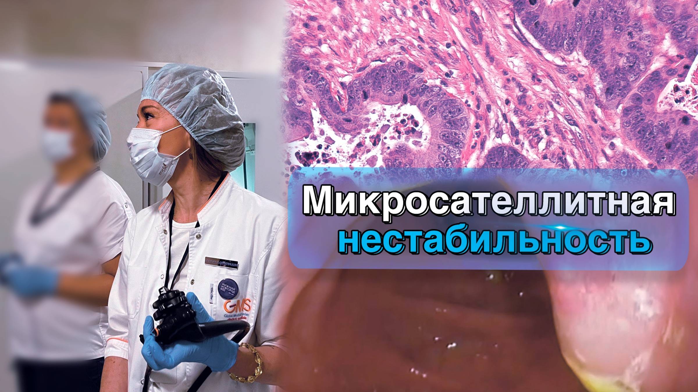 Зубчатая аденокарцинома: диагностическая дилемма