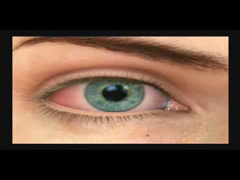 Синдром сухого глаза