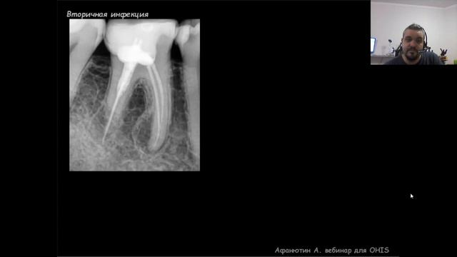Вебинар №6 - Микробиология корневых каналов. Базовые знания для успешного принятия решений.