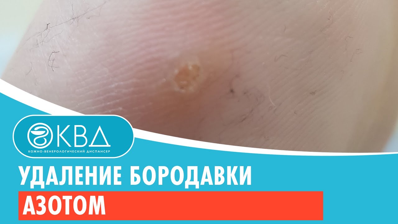 ✅ Удаление бородавки азотом. Клинический случай №194