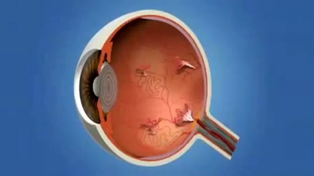 Диабетическая ретинопатия