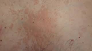 Цветной (разноцветный лишай легко вылечить без таблеток.