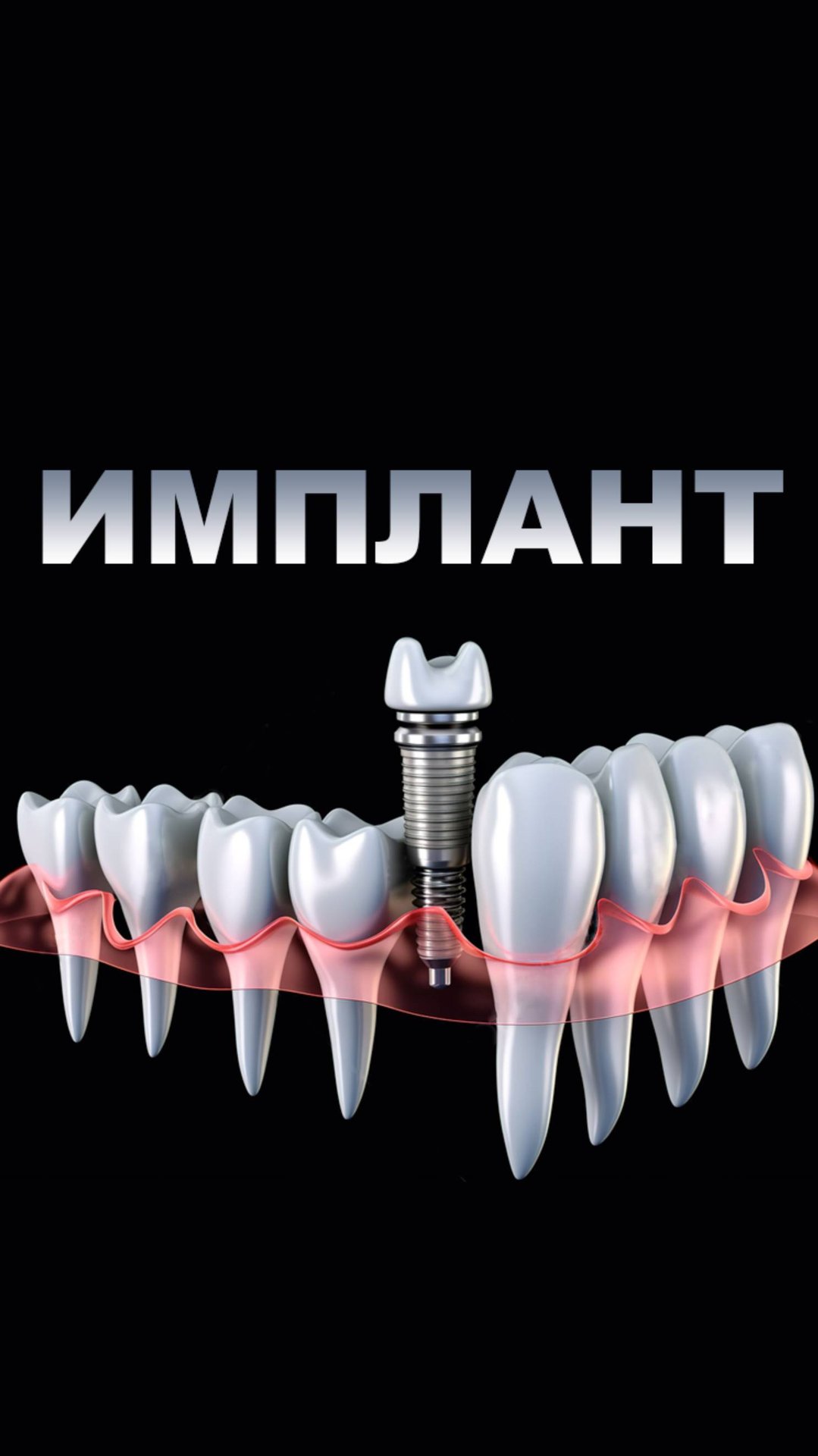 Имплант зуба #имплантациязубов #стоматология #зубы