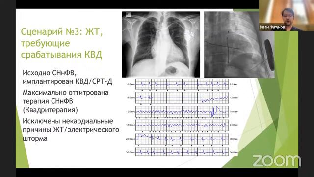 Пациент после лечения желудочковой тахикардии