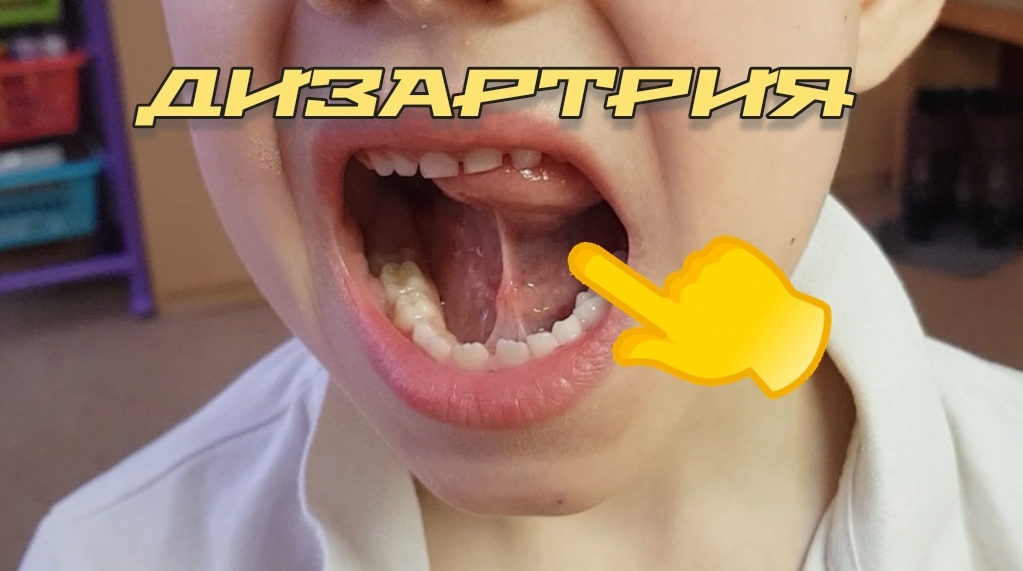 Дизартрия и ее проявления.