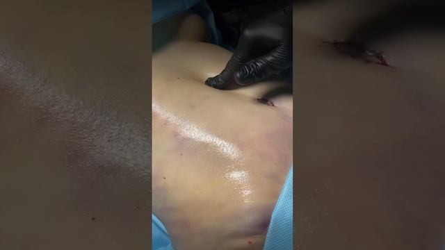 Абдоминопластика // пластика живота / пластическая хирургия