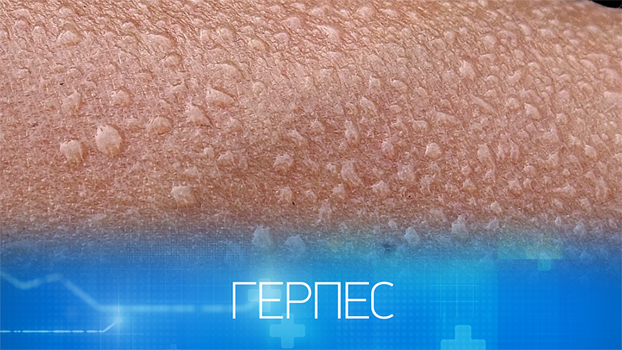 Герпес