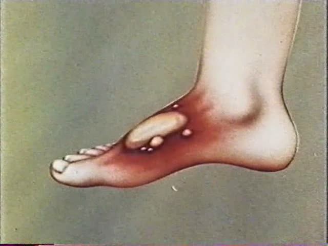 ОБЖ-НВП. Первая медицинская помощь. Первая помощь при ожогах