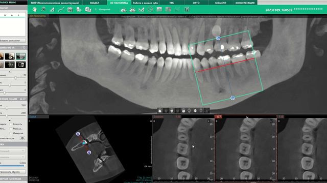 Визуализация каналов зуба для терапевтов (движение вдоль канала)