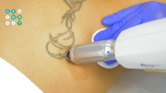 УДАЛЕНИЕ ТАТУИРОВОК И ТАТУАЖА НА АППАРАТЕ Harmony XL Сеть клиник косметологии GEN87