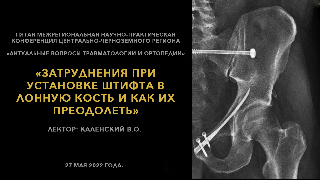 Затруднения при установке штифта в лонную кость и как их преодолеть