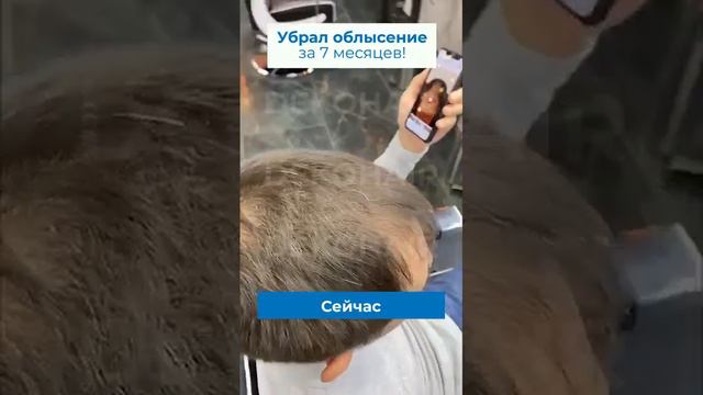 Победил мужское облысение за 7 месяцев. Отзыв о лосьоне