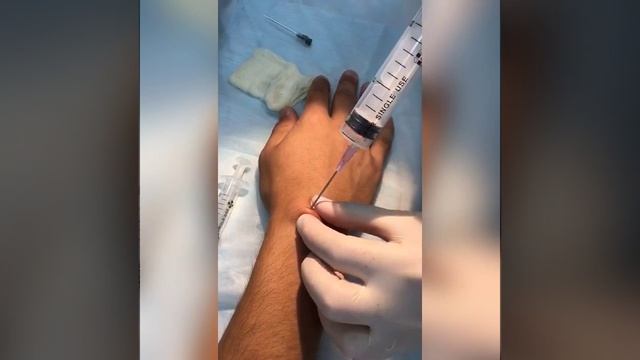 Пункционной метод лечение гигромы кисти в Уфе.mp4