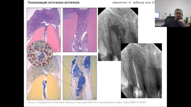 Вебинар №5 - Битва за стерильность, или лечение инфицированных каналов.