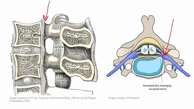 USMLE RX - 8.Анатомия - 1.Анат,физо - 15.Признаки пояснично-крестцовой радикулопатии