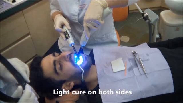 eBrace — фиксация брекетов