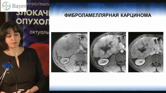 МРТ злокачественных образований печени