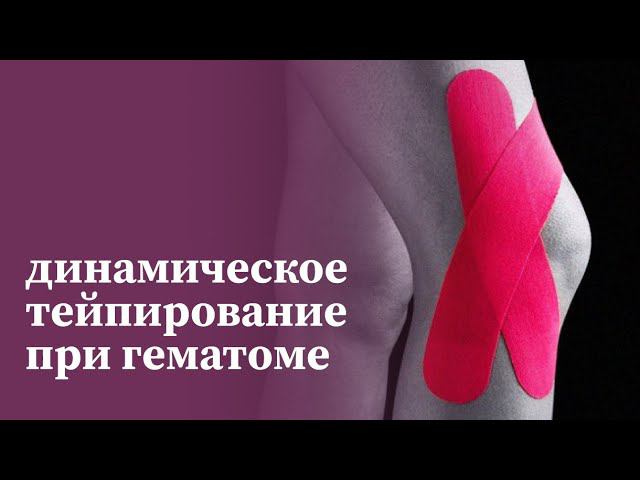 Способы реабилитации: тейпирование от МАМР | Кинейзиотейпинг | МАМР