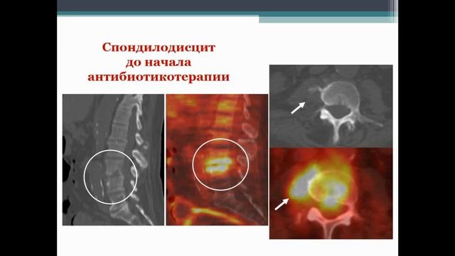 ПЭТ КТ в диагностике инфекции и воспаления