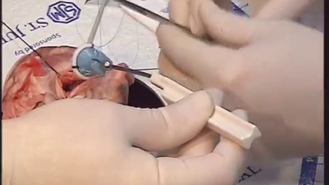 Aortic Valve replacement- Semi continuous suture