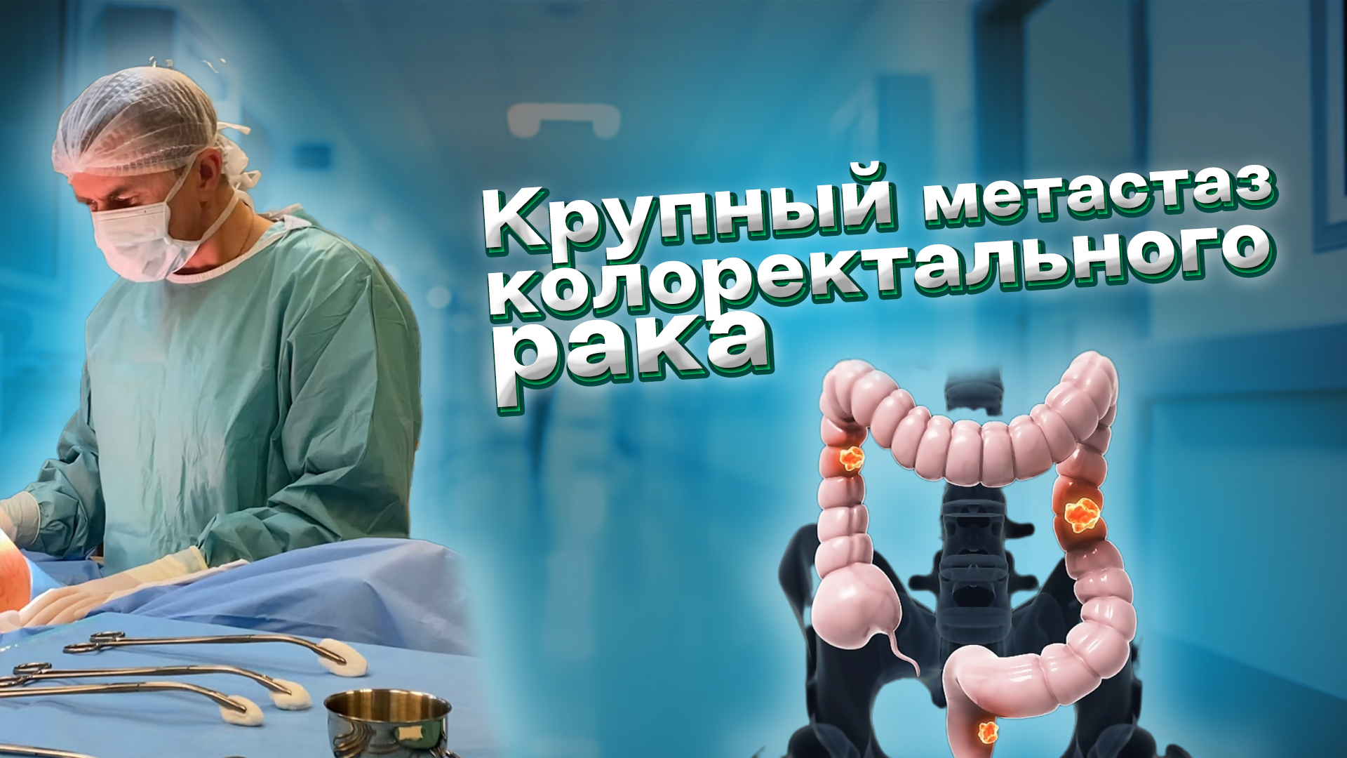 Метастаз колоректального рака