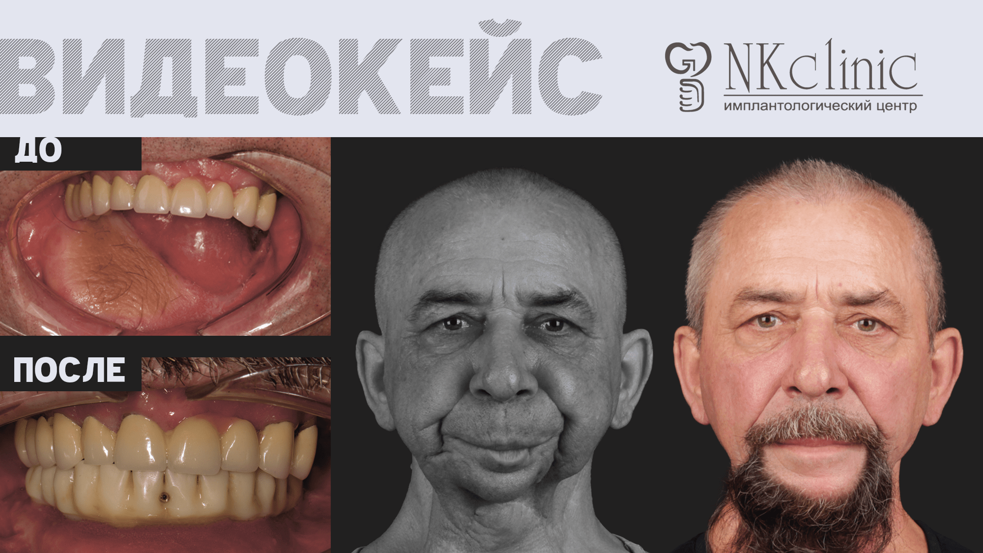 Восстановление утраченной нижней челюсти