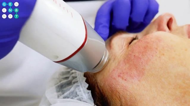 Микроигольчатый RF лифтинг INFINI Сеть клиник косметологии GEN87 в Москве