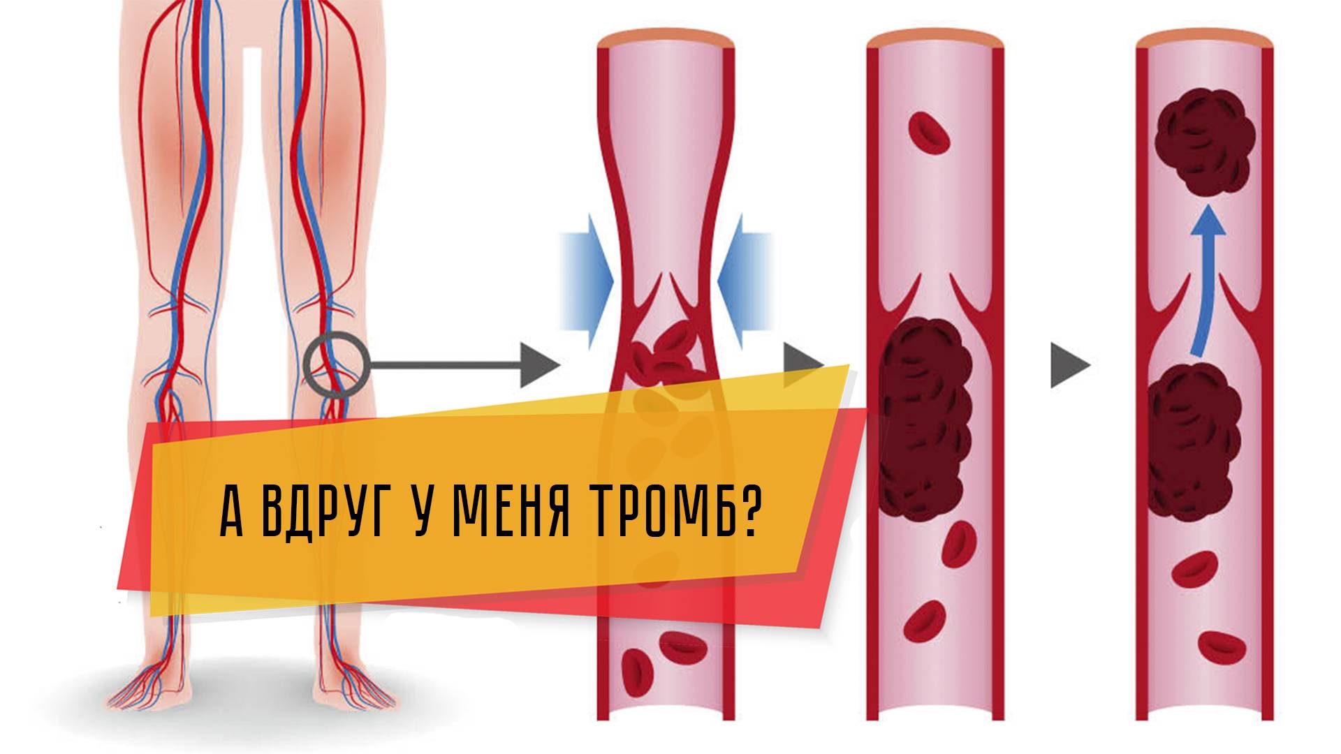 А вдруг у меня тромб??