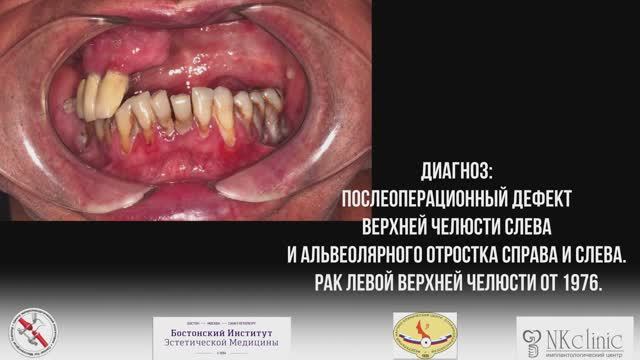 Восстановление левой верхней челюсти и альвеолярного отростка справа и слева после онкологии