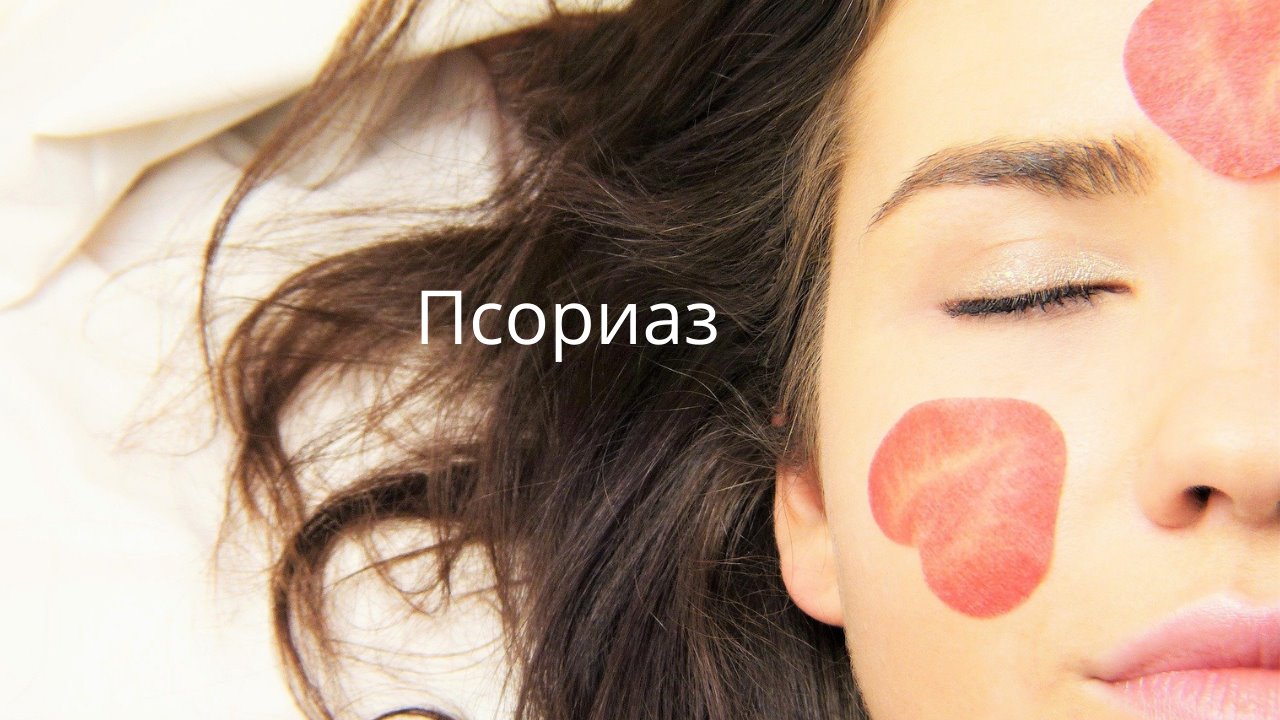 Псориаз