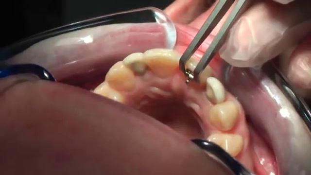 Пинцет для 2D лингвальных брекетов, Dr. Björn Ludwig