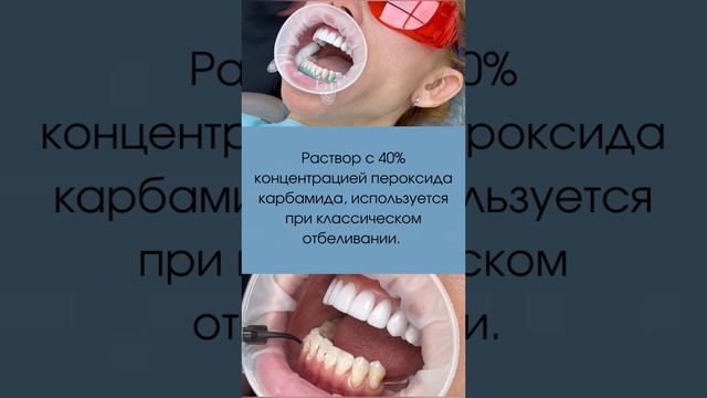 Как проходит процедура отбеливания зубов