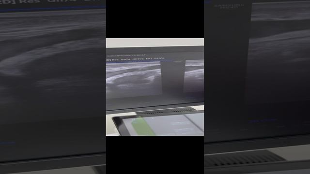 Ошибка хирурга. Рецидив варикоза. Узи сосудов. Сосудистый хирург. Флеболог Москва