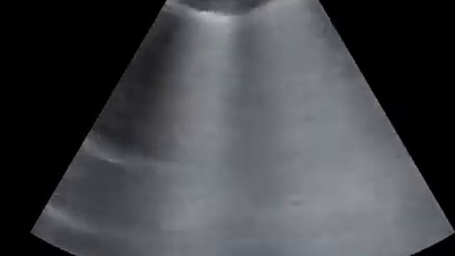 Множественные В - линии при кардиогенном отеке легких у собаки