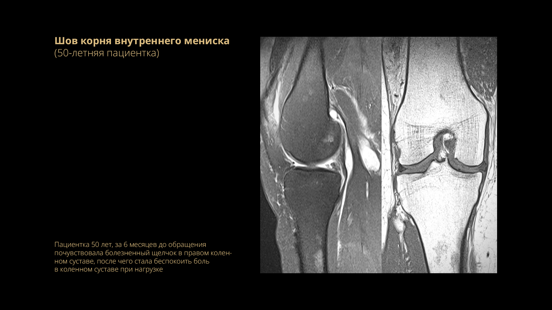 Шов корня внутреннего мениска (50-летняя пациентка)